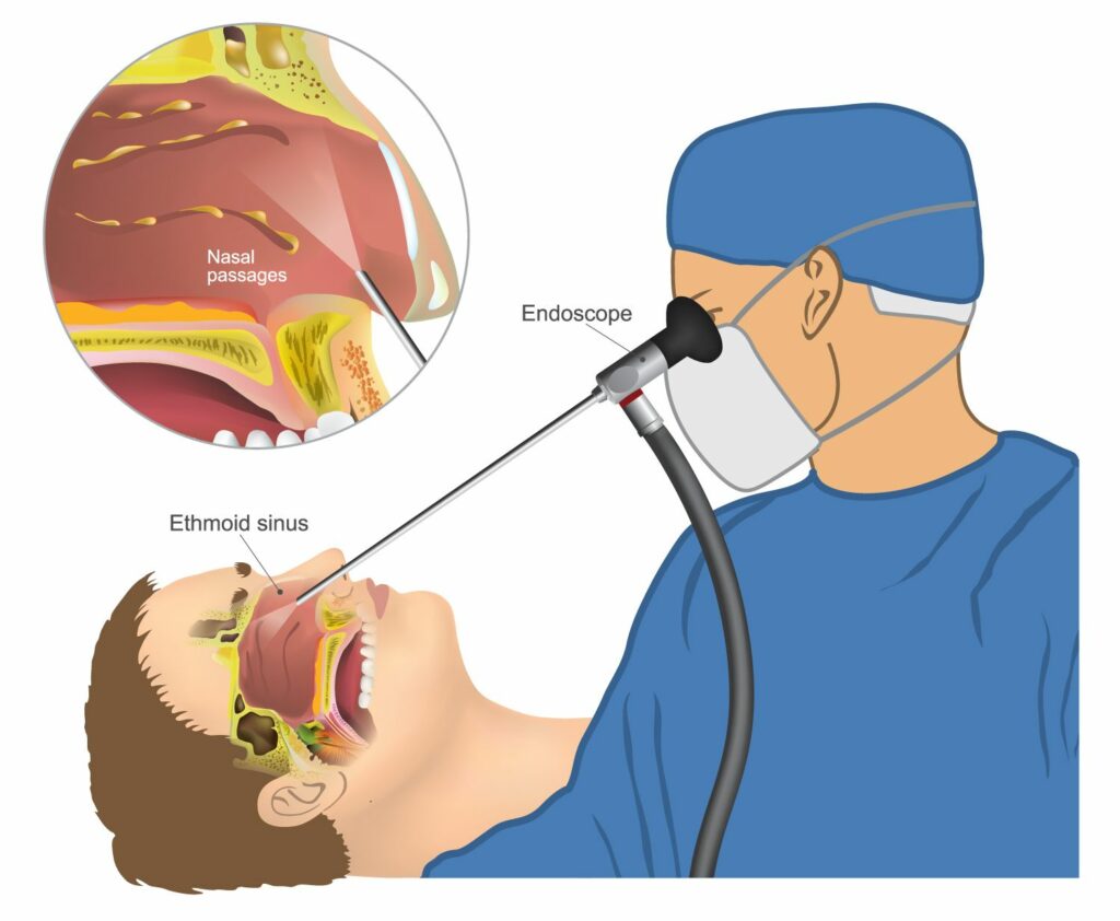 Preparing for Functional Endoscopic Sinus Surgery: What to Expect ...